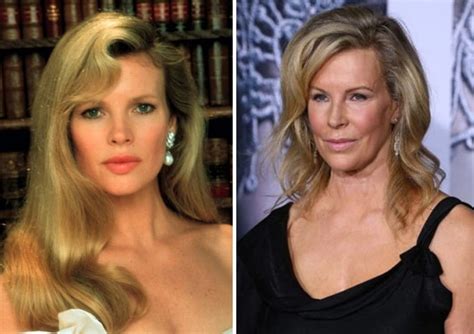 Kim Basinger Before And After Plastic Surgery