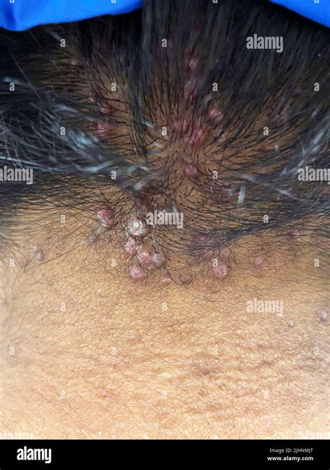Acne Keloidalis Nuchae Stock Photo Alamy