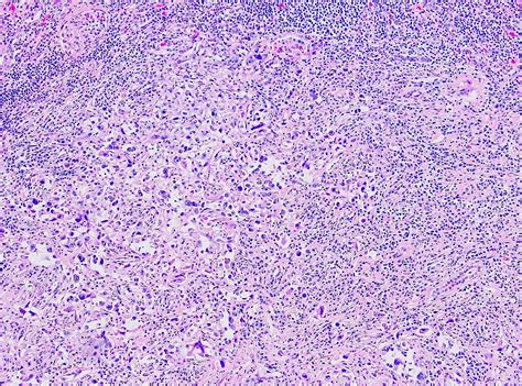 Pathology Outlines Sarcomatoid
