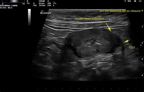 Bladder Mass With Renal Dystrophy Suspect Transitional Cell Carcinoma Tcc In A 11 Year Old Mn