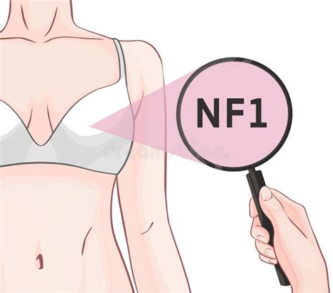 Variants In The Nf1 Gene Are Associated With An Increased Risk Of Developing Breast Cancer Stock