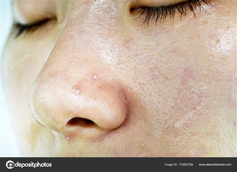 입술에 흰 여드름