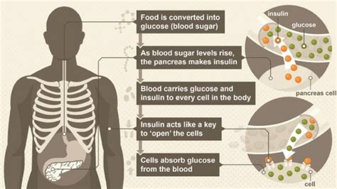 Type Diabetes Overview