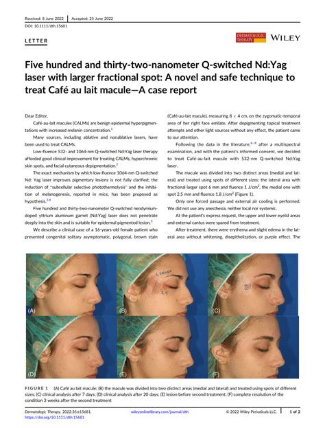 532 Nm Q‐switched Nd Yag Laser With Larger Fractional Spot A Novel And Safe Technique To Treat