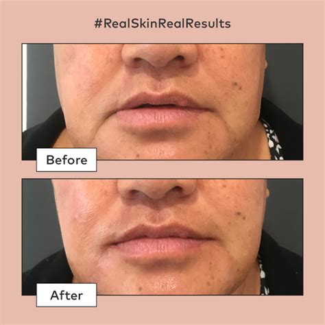 Skin 101 Botox And Xeomin Caci