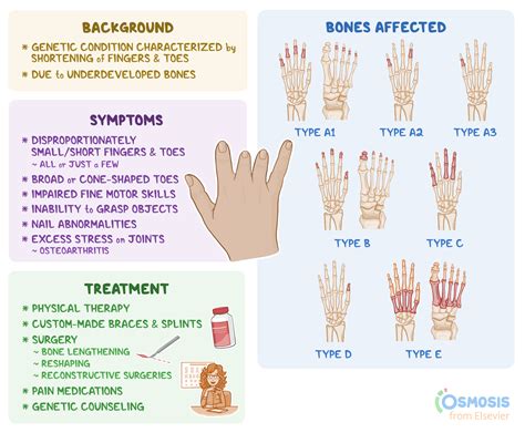 Brachydactyly What Is It Causes Symptoms And More Osmosis