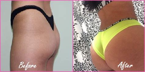 Buttock Augmentation How To Transform Your Personality