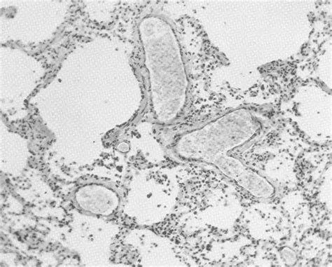 Figure 1 From Is There An Entity Primary Pulmonary Hypertension