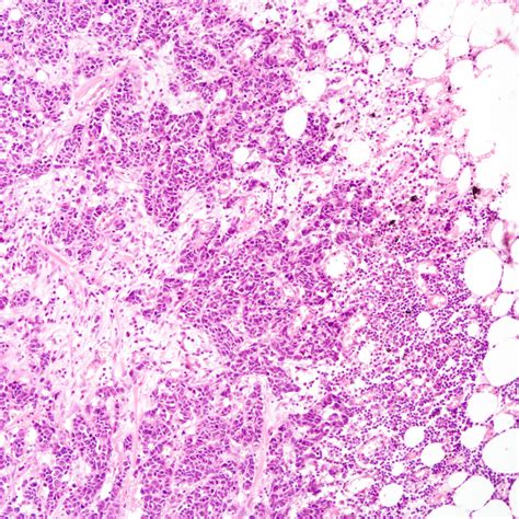 Pathology Outlines Neuroendocrine Carcinoma Nec