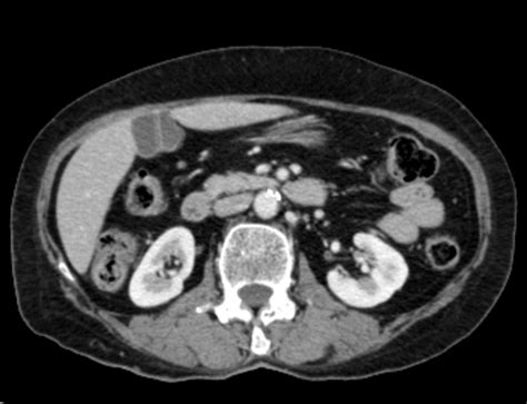 Radiopaedia Case Phrygian Cap Id 68277 Study 77788 Nc Commons