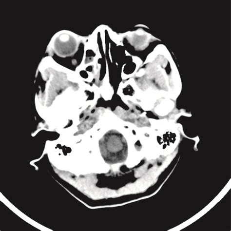 Case 1 Computed Tomography Ct With Partial Occupation Of Right