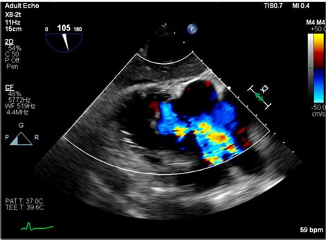 Transgastric Right Ventricular Inflow Color Doppler Tee View