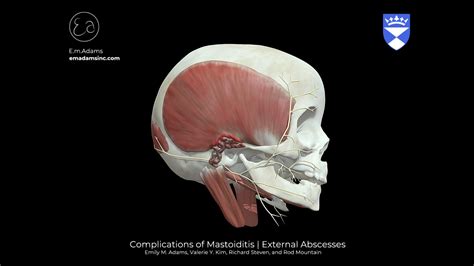 Zygomatic Abscess 3d Model By University Of Dundee Cahid Anatomydundee 4b5277b Sketchfab