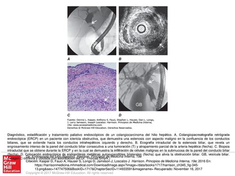 Diagnóstico, estadificación y tratamiento paliativo endoscópicos de un colangiocarcinoma del ...
