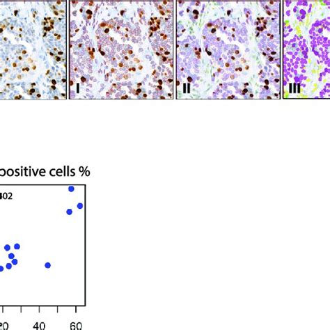 Automated Ki67 Scoring By Artificial Intelligence A Image Analysis Download Scientific Diagram