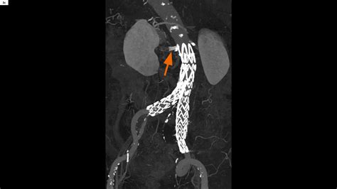 Isolated Common Iliac Artery Aneurysm Siemens Healthineers Usa