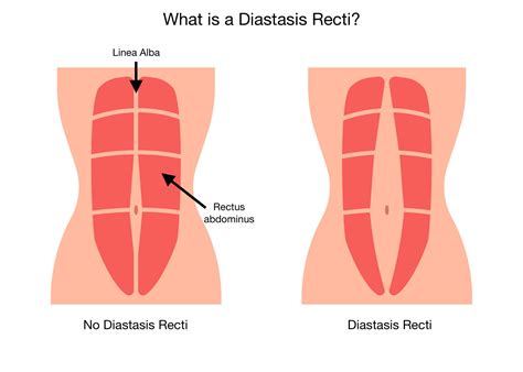How To Fix Diastasis Recti With Emsculpt Neo In 6 Weeks Colowell