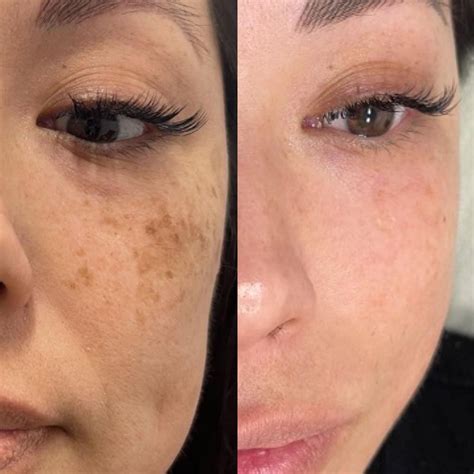 Laser Skin Resurfacing Types Effects Risks Cost