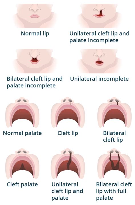 Cleft Lip And Palate New Born Girl Aged 1 Week With Unilateral Cleft