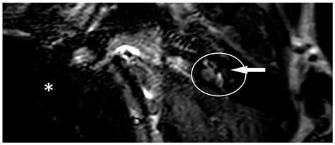 Endolymphatic Hydrops Mri Intratympanic Gentamicin A 1 Day Protocol