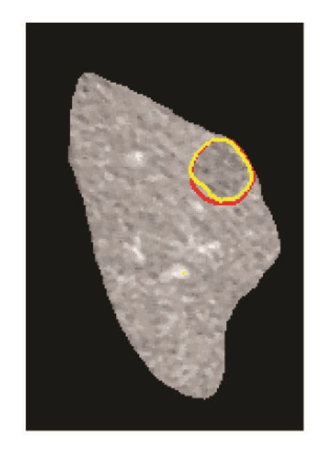 Comparisons Between Tumor Segmentation Results And Ground Truth Yellow