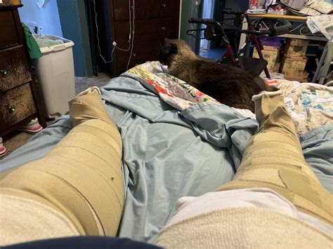 Farrow Wraps R Lymphedema