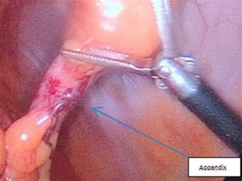 The Appendix Was Seen Normal Download Scientific Diagram