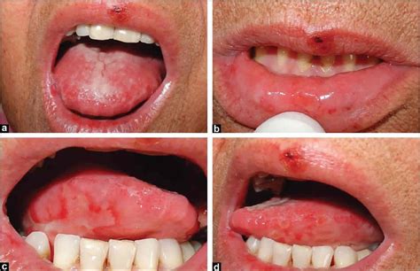 Oral Mucositis Definition Causes Symptoms Treatment Guidelines