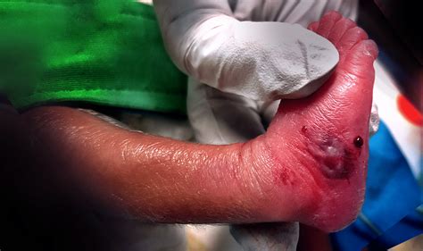 Understanding Extravasation When Ivs Go Wrong Ivwatch