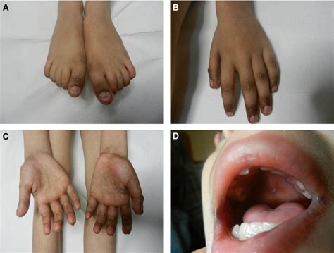 Reticulated Hyperpigmentation On The Extensor Surfaces Of The Proximal