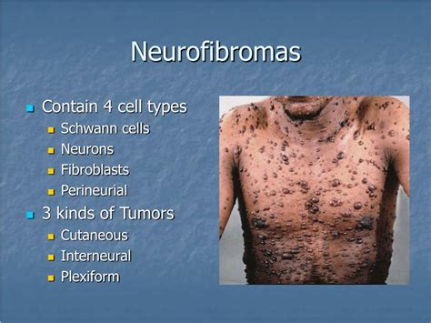 Ppt Nf1 Neurofibromatosis Powerpoint Presentation Free Download Id 3753222