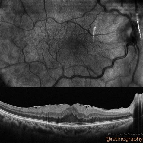Epiretinal Membrane Retinography