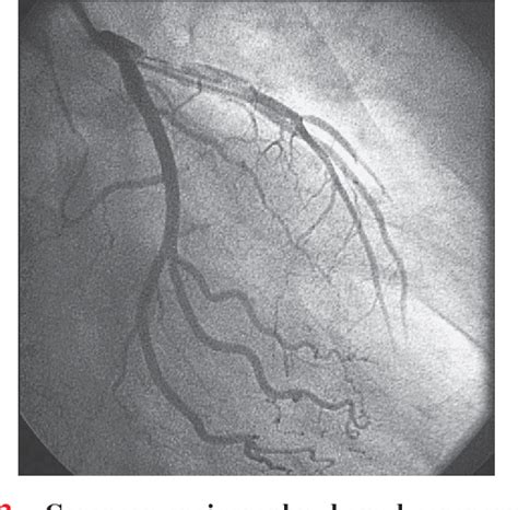 Contusion Of Chest Semantic Scholar