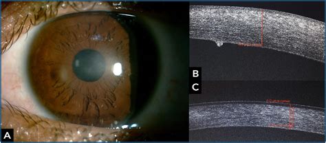 Disciform Herpetic Endotheliitis Appearance On Anterior Segment
