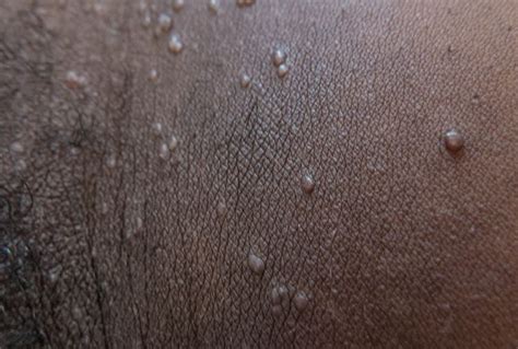 17 Common Causes Of Raised Skin Bumps With Pictures