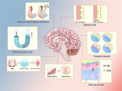Hydrocephalus Related To Choroid Plexus Epithelium There Are Many Download Scientific Diagram