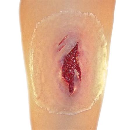 Laceration Liver Injury And Regeneration Current Understanding New