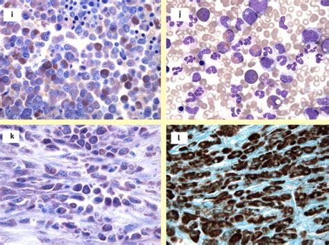 Bone Marrow Disorders With Associated Eosinophilia Diagnostic Histopathology