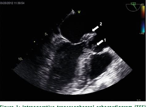 Figure 1 From Aortic Root Abscess And The Lost Art Of The Physical Exam