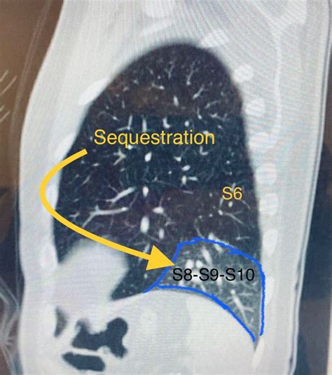 Uniportal Vats Segmentectomies As A Lung Sparing Technique Combined