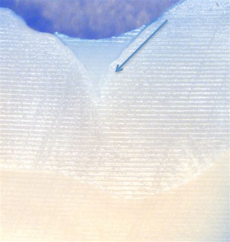 Figure 10 From The Effect Of Pit And Fissure Morphology And Sealant