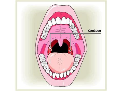 Имам налепи по сливиците трябва ли да ги извадя