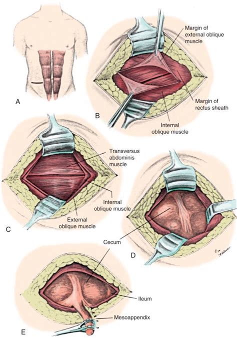 Open Appendectomy Incision