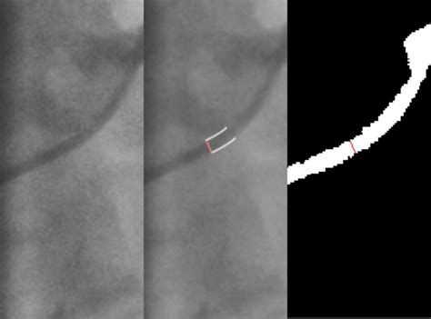 Catheter Segmentation Assessment Left To Right Original Image