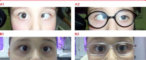 Figure 1 From Surgical Treatment For Partially Accommodative Esotropia