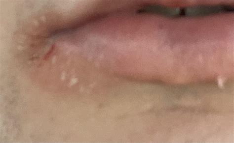 Angular Cheilitis R Dermatologyquestions
