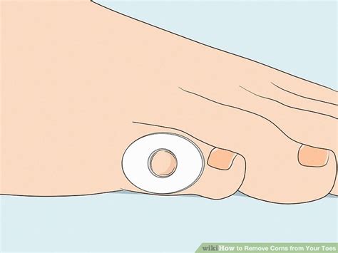 How To Remove Corns From Your Toes 12 Steps With Pictures