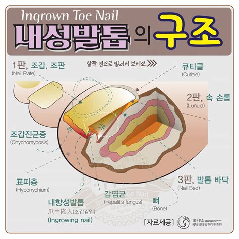 포쉬네일 다산역점 내성발톱 고통에서 해방시켜 드립니다~ 네일계정👉 Forsythe Jinjeop ☝️신규고객 네이버예약은 요기클릭 문의전화 031 572 4245