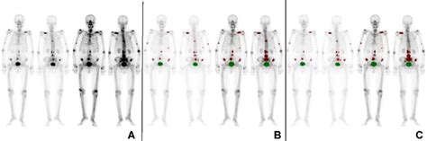 Results Of Data Synthesis A Original Bone Scan Image B Manually Download Scientific