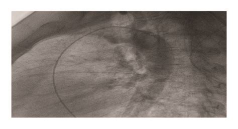 Aortic Angiogram Showing Presence Of A Small Pda Download Scientific Diagram